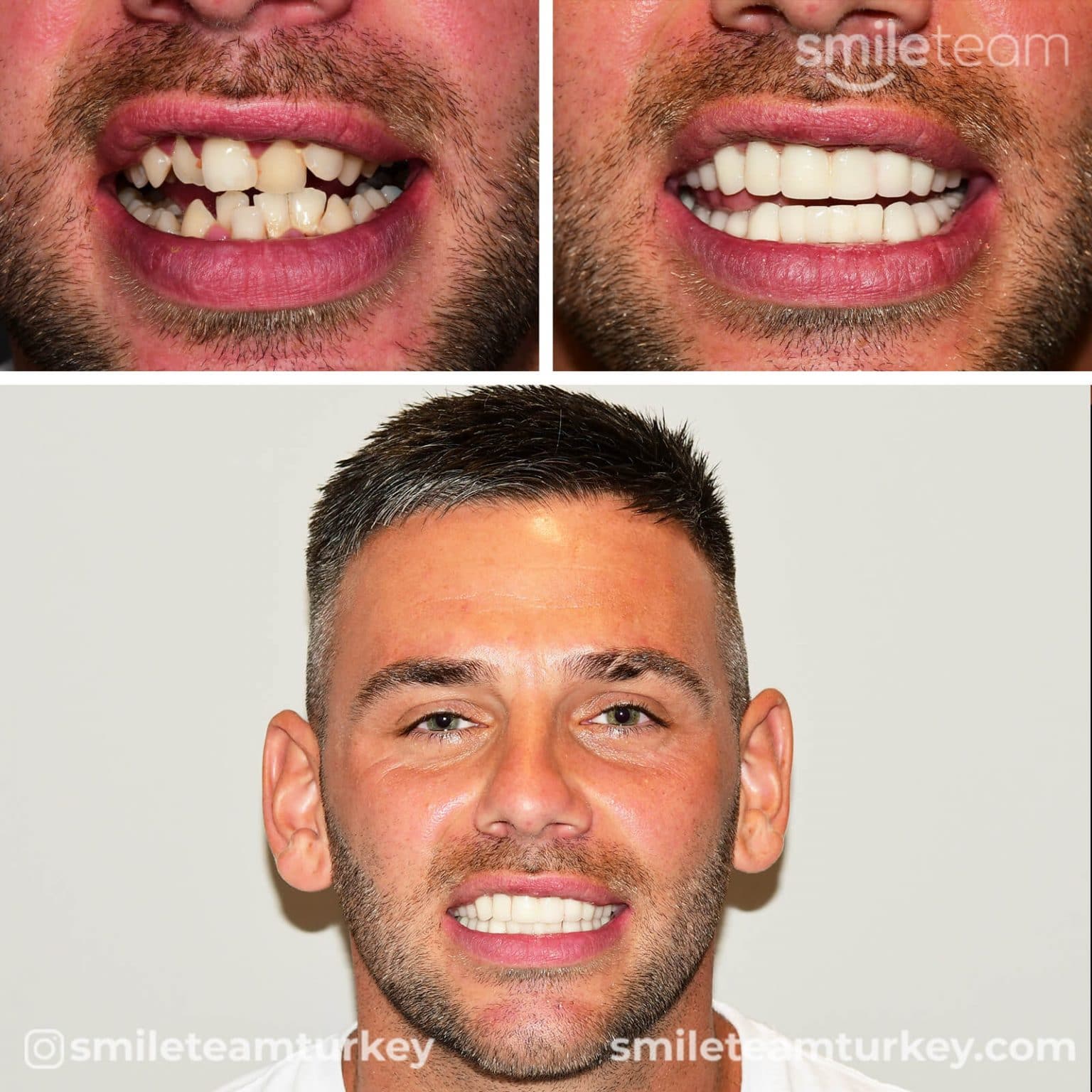 Turkey Teeth Before After Photos | Smile Team Turkey
