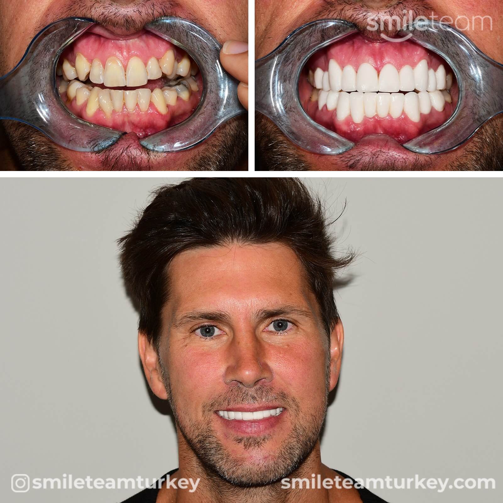 Turkey Teeth Before After Photos | Smile Team Turkey