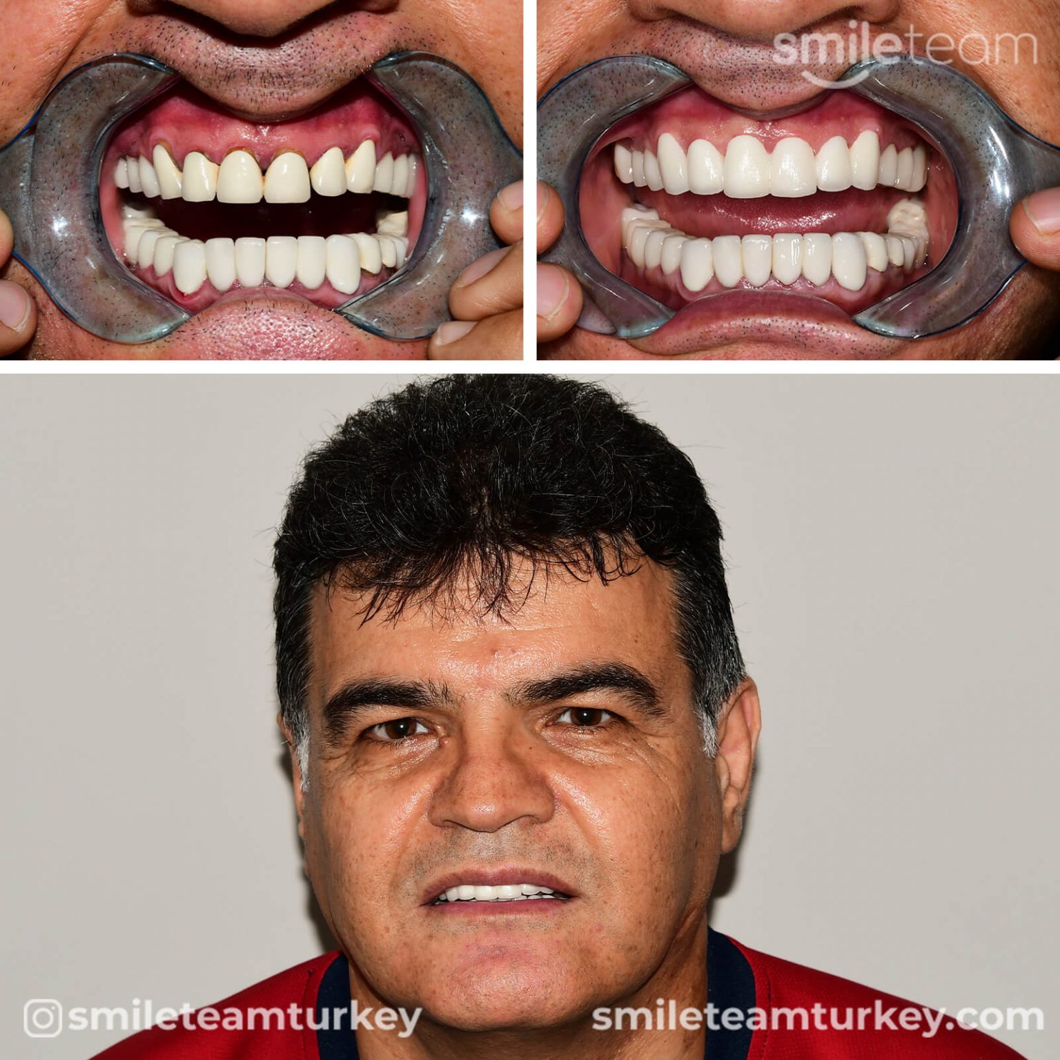 Turkey Teeth Before After Photos | Smile Team Turkey