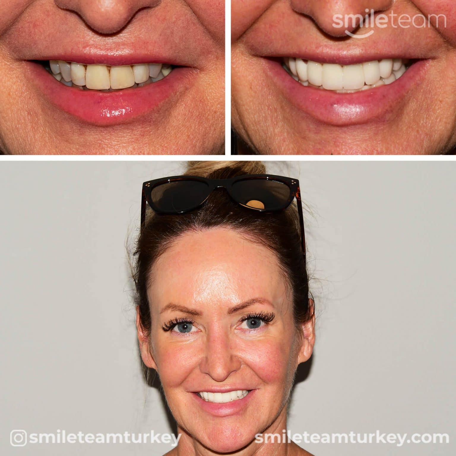 Turkey Teeth Before After Photos | Smile Team Turkey