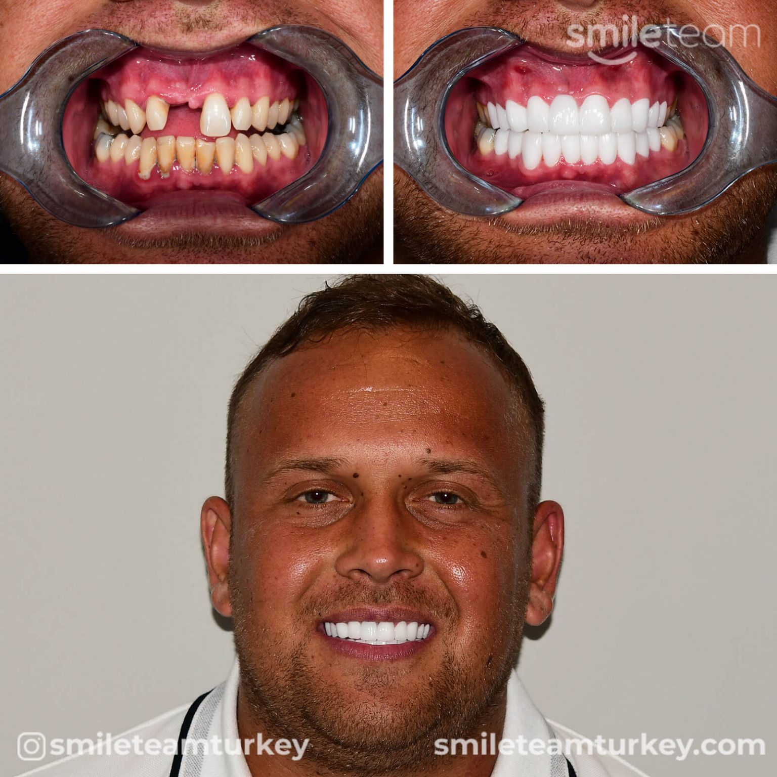 Turkey Teeth Before After Photos | Smile Team Turkey