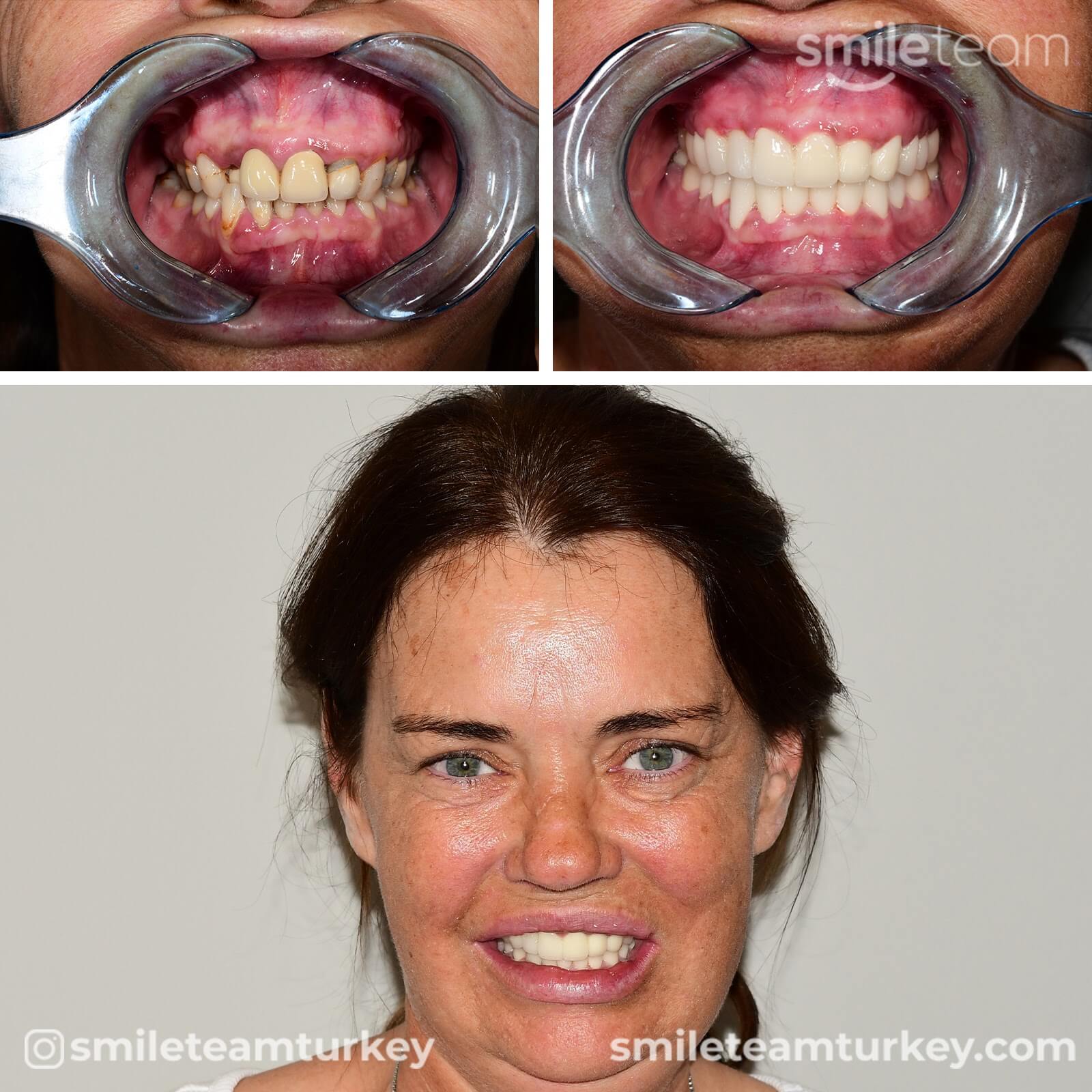 Turkey Teeth Before After Photos | Smile Team Turkey