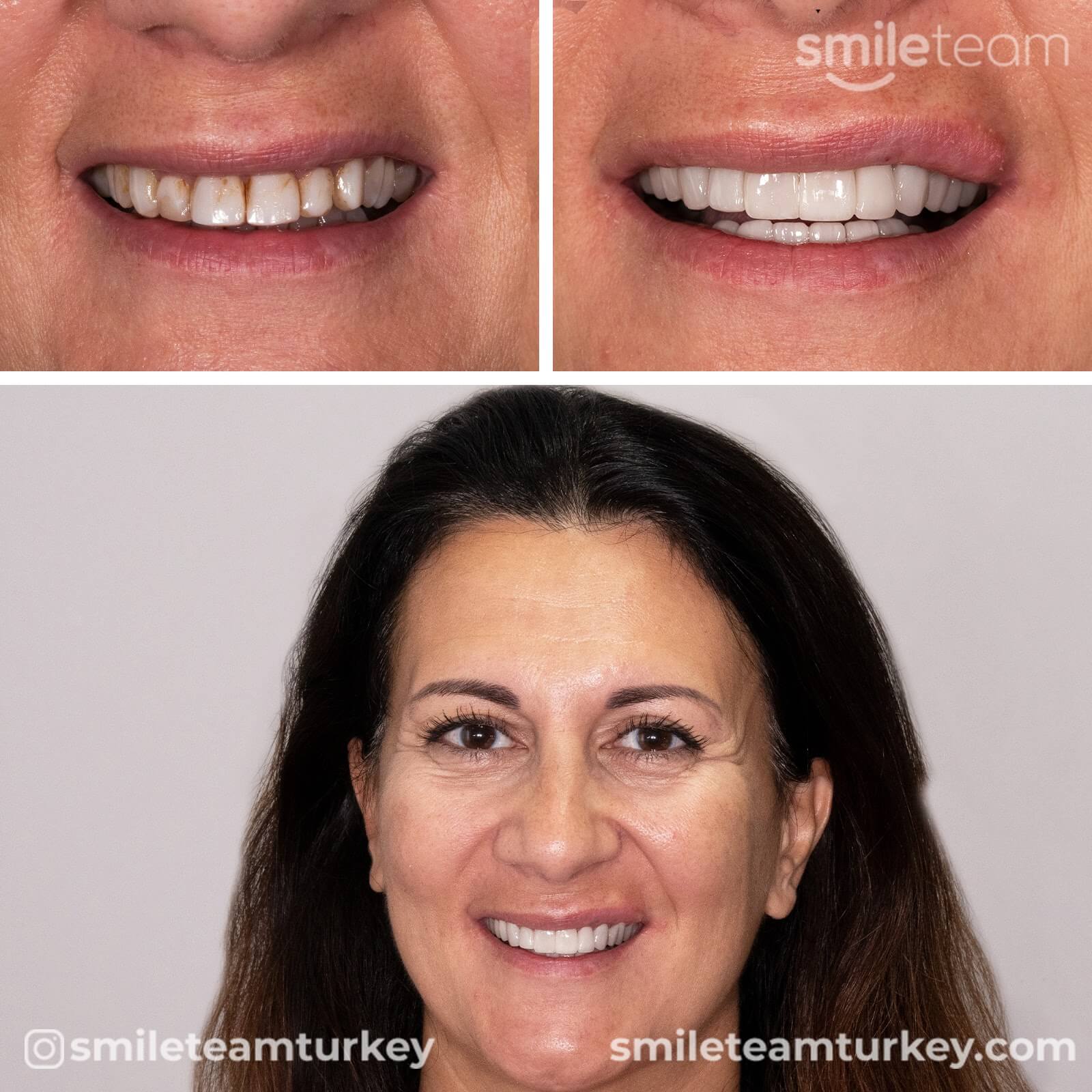 Turkey Teeth Before After Photos | Smile Team Turkey