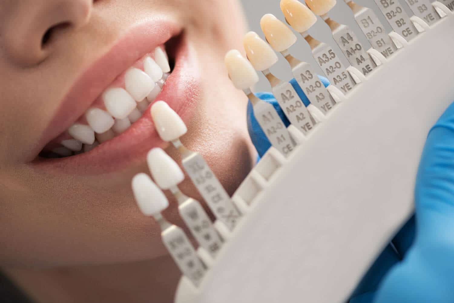 Dental Crowns Purpose Procedure Complications Cost In Turkey Dental Crowns Purpose Procedure Complications Cost In Turkey