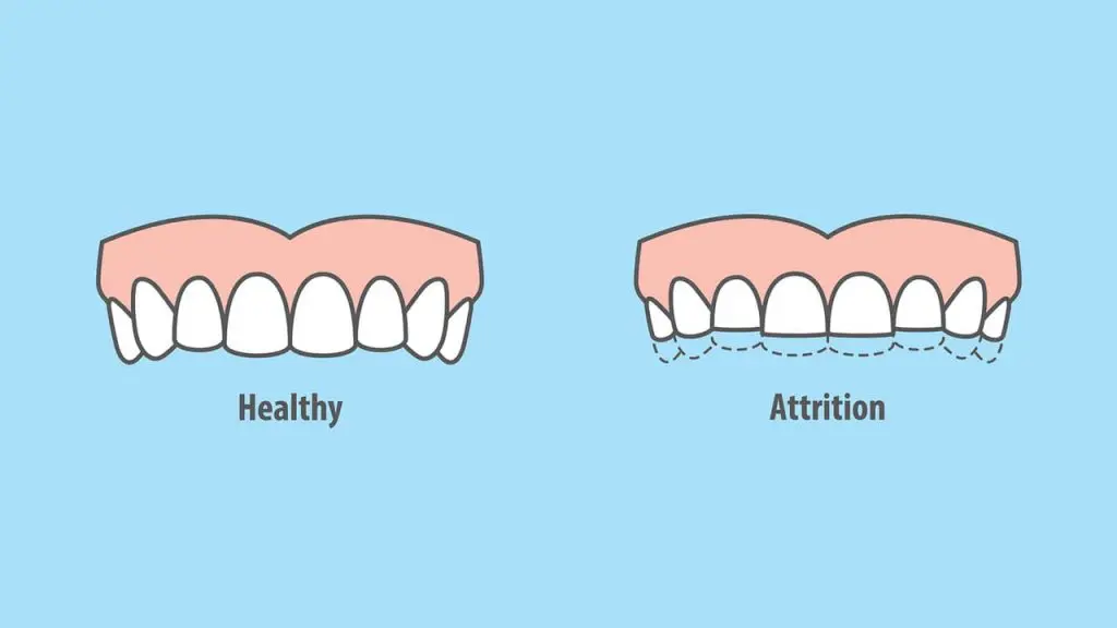 Clenching And Grinding Teeth: Handling These Nasty Habits