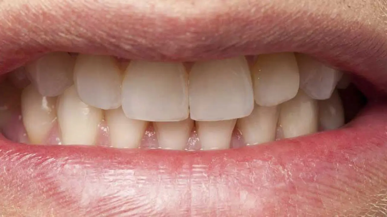 Clenching And Grinding Teeth: Handling These Nasty Habits