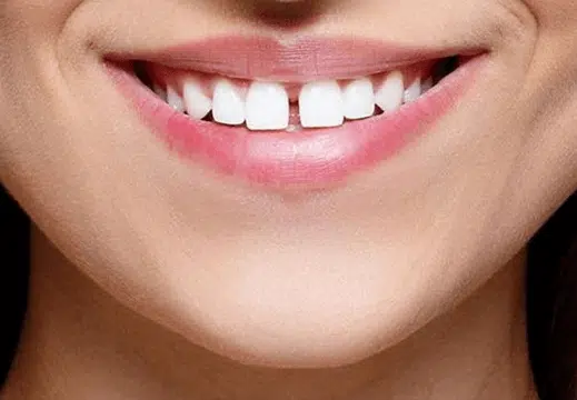 What Is Diastema? - Smile Team Turkey