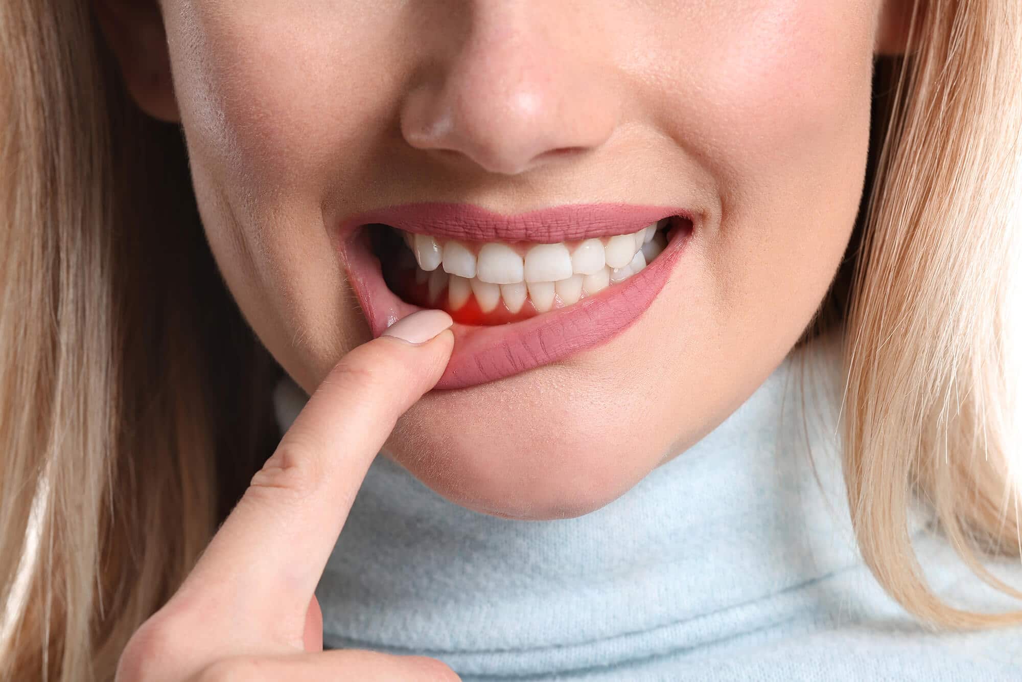 Bleeding Gums Causes And Solutions - Smile Team Turkey