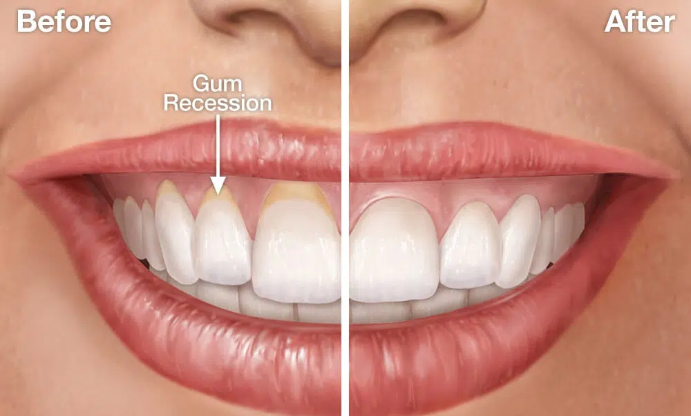 Gum Recession Symptoms And Treatment Smile Team Turkey