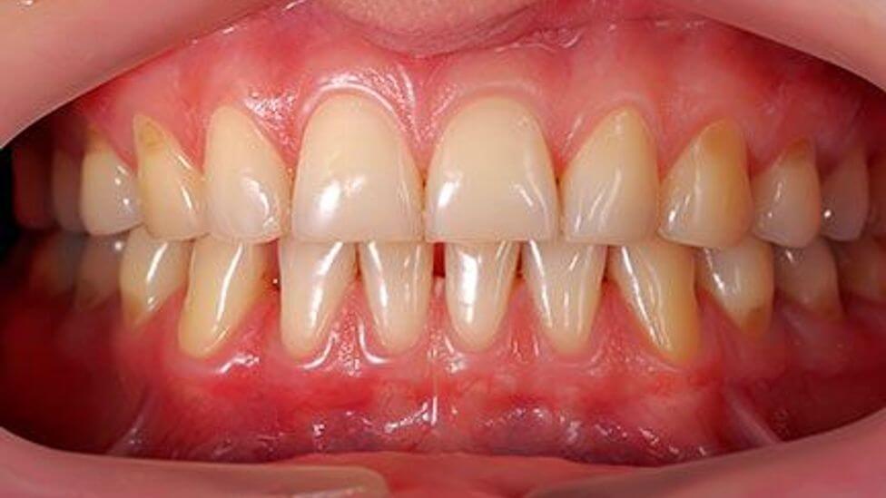 Aging Changes In Teeth And Gums - Smile Team Turkey