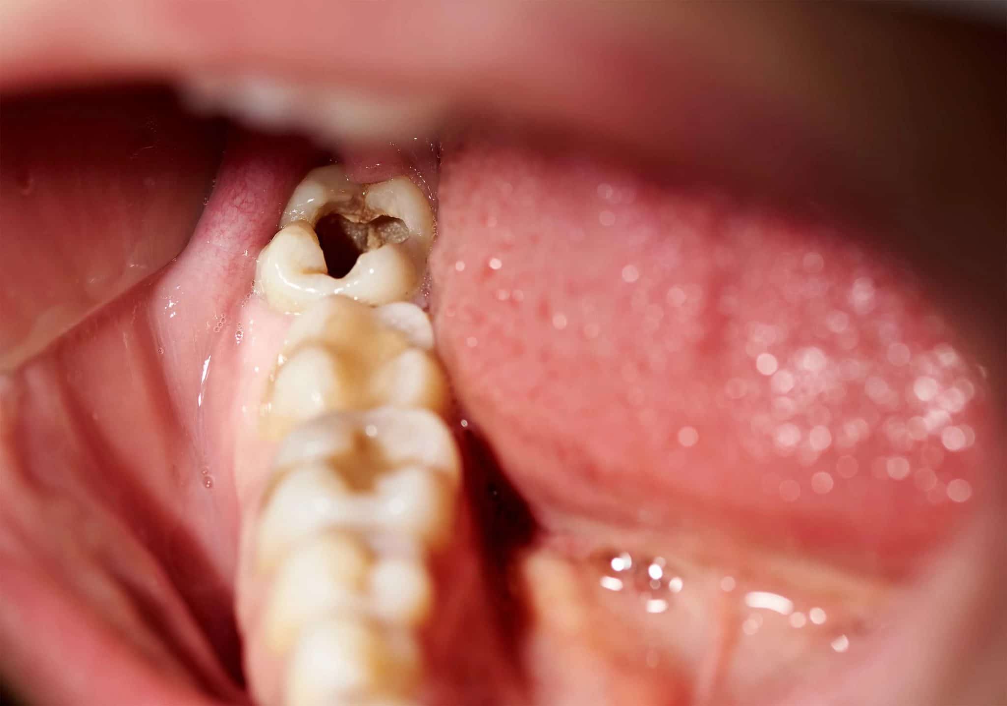 Dental Caries In Adults Smile Team Turkey dental-caries-in-adults-smile-team-turkey