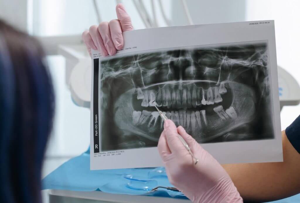 What Are Dental X-Rays? - Smile Team Turkey