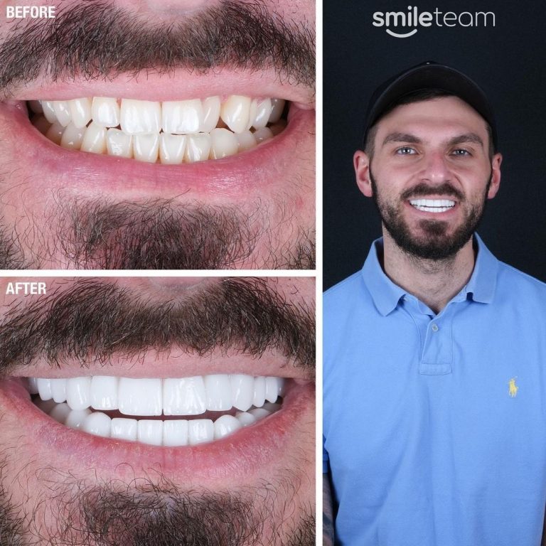 Turkey Teeth Before After Photos | Smile Team Turkey