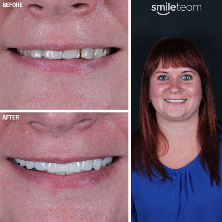 Turkey Teeth Before After Photos | Smile Team Turkey