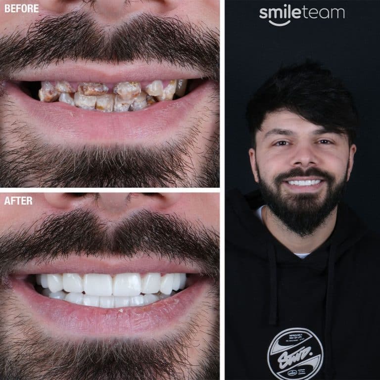 Turkey Teeth Before After Photos | Smile Team Turkey