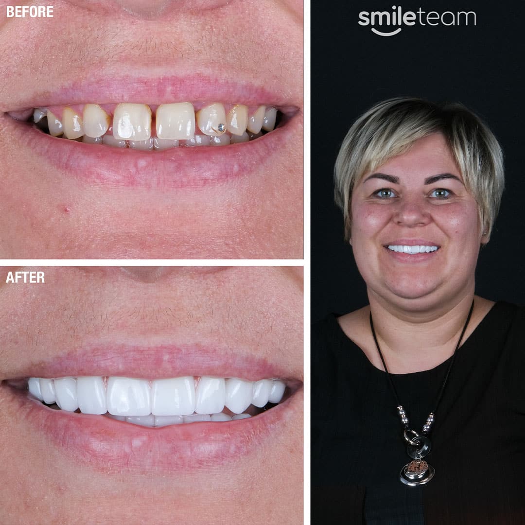 Turkey Teeth Before After Photos | Smile Team Turkey
