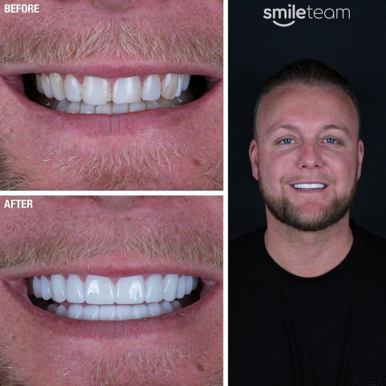 Turkey Teeth Before After Photos | Smile Team Turkey