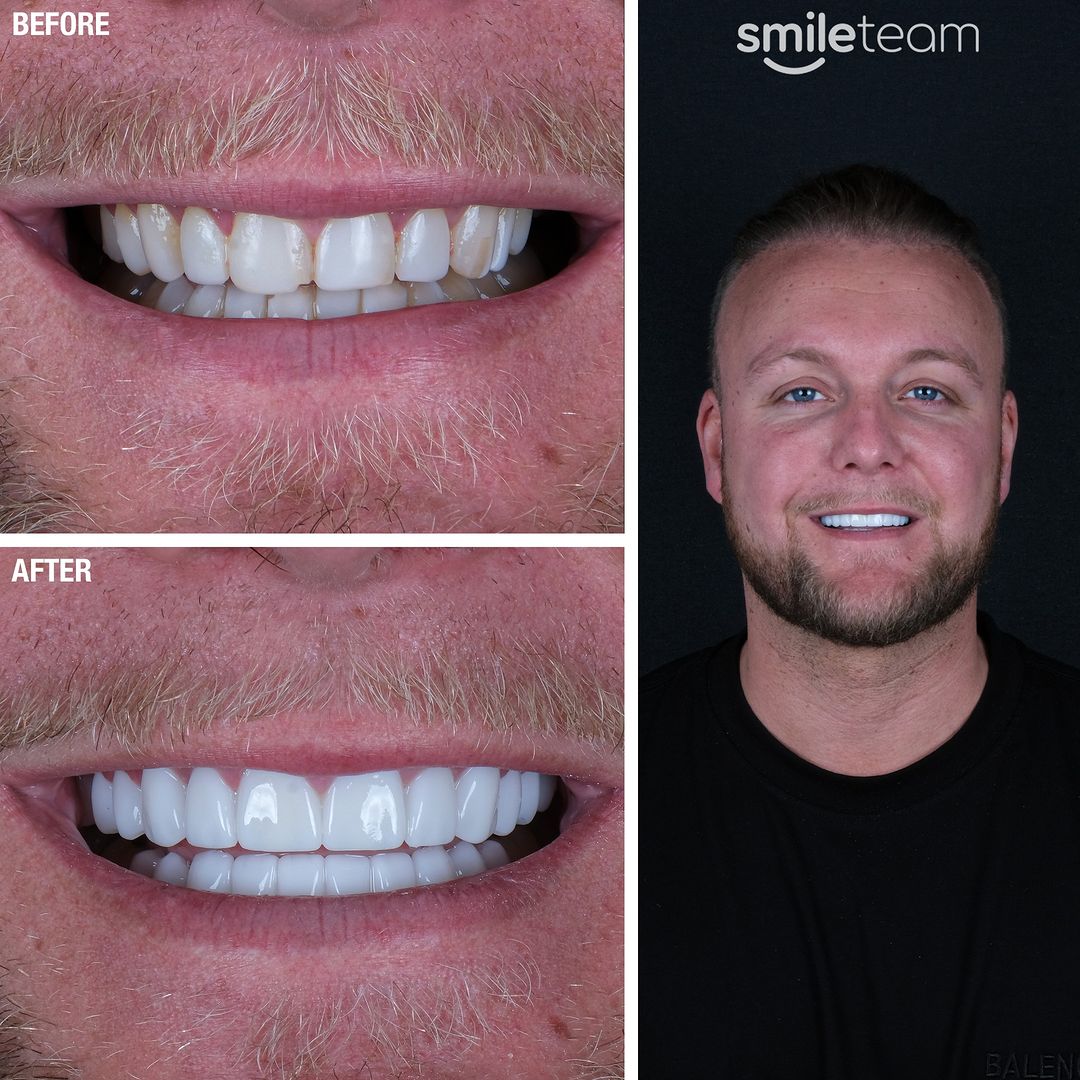 Turkey Teeth Before After Photos | Smile Team Turkey