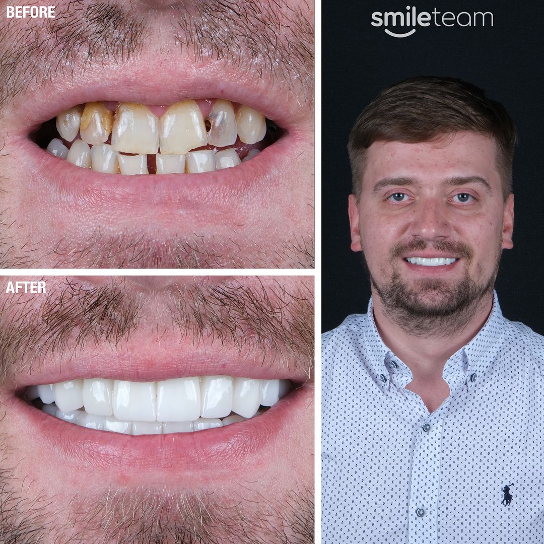 Turkey Teeth Before After Photos | Smile Team Turkey
