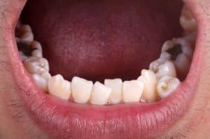 Hyperdontia: Causes, Diagnosis, And Treatment Options - Smile Team Turkey