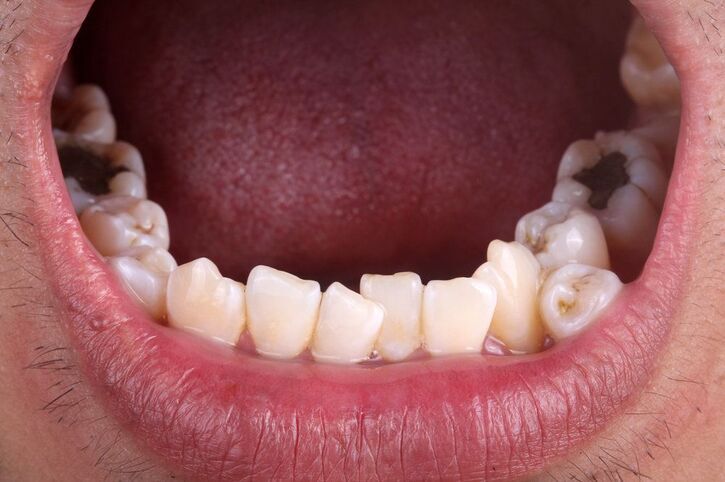 Hyperdontia: Causes, Diagnosis, And Treatment Options - Smile Team Turkey