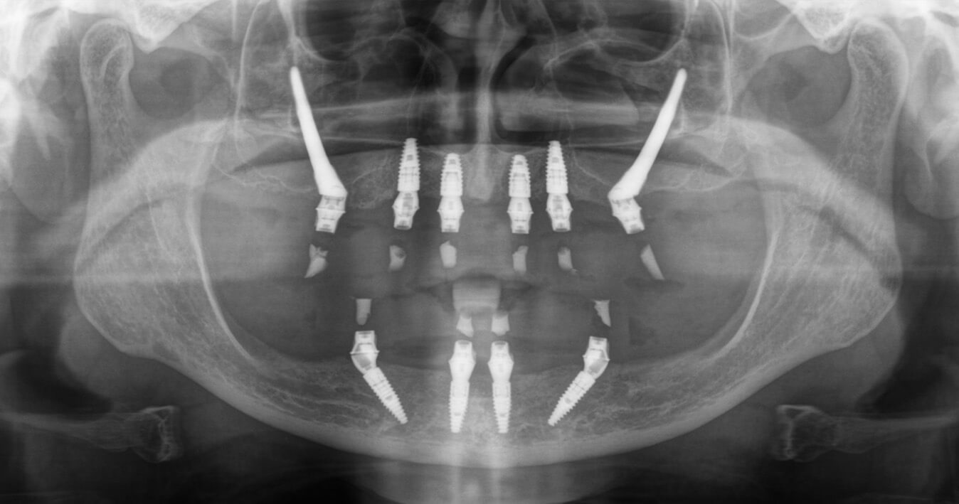 Zygomatic Implants In Turkey: Enhance Your Smile Today