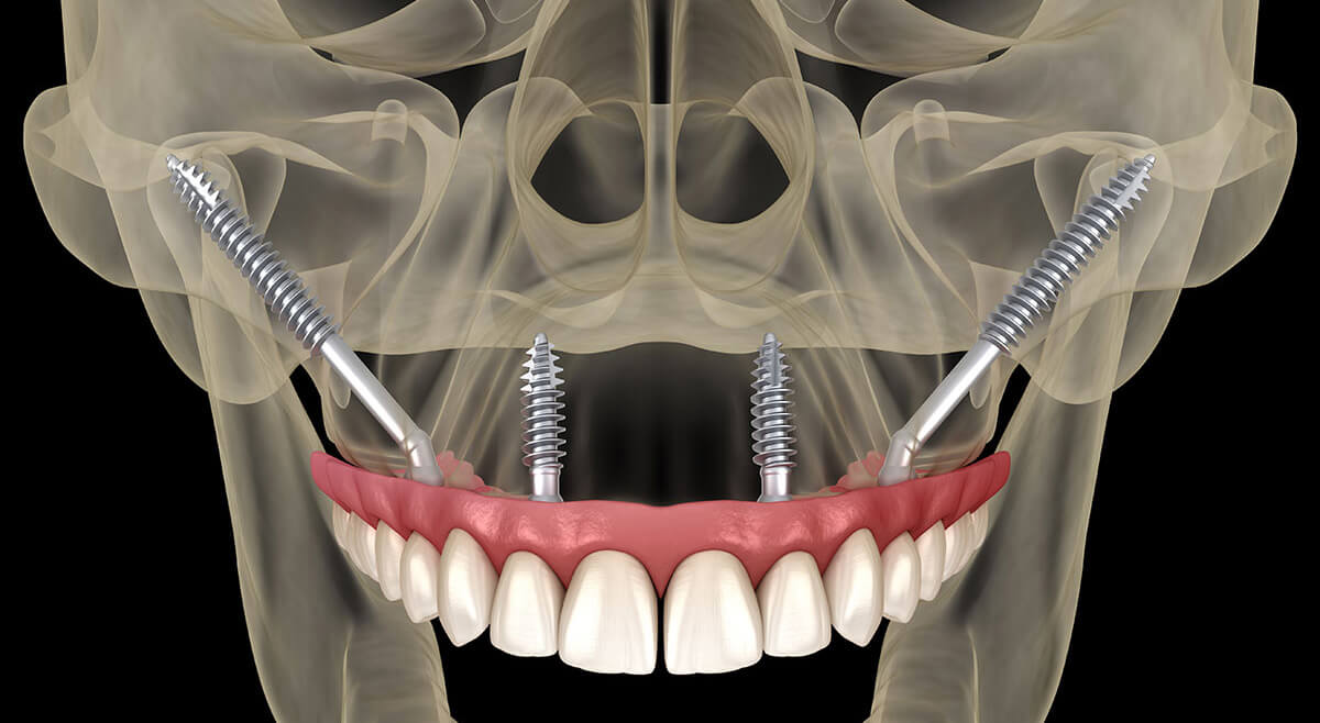 Zygomatic Implants - Smile Team Turkey