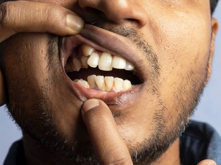 Hyperdontia: Causes, Diagnosis, And Treatment Options - Smile Team Turkey